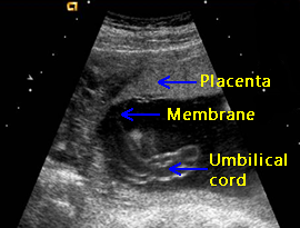 Velamentous Cord Insertion - OB Images