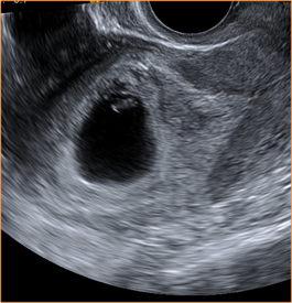 2 Weeks Miscarriage Fetal Tissue