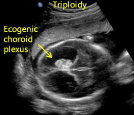 Gallery 9: triploidy - OB Images
