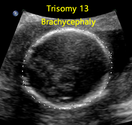 Trisomy 13 on emaze